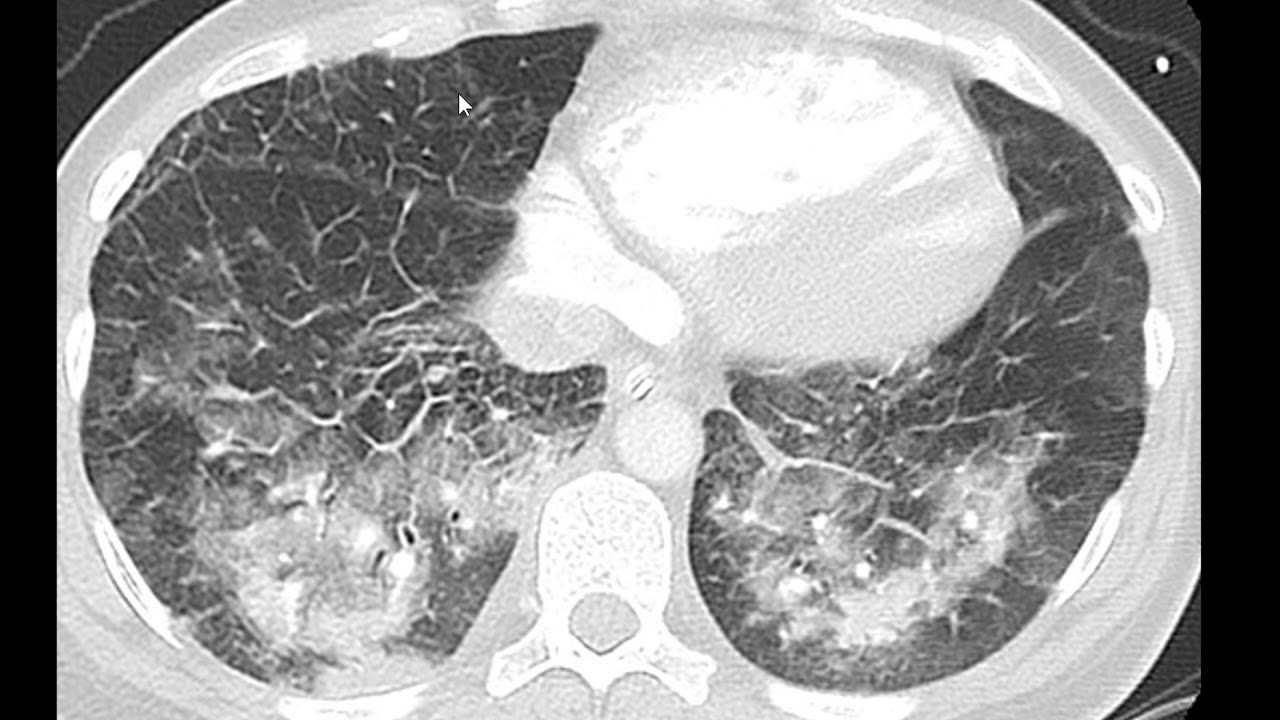 Edema pulmonar intersticial cardiogênico: causas, sintomas e tratamento ...