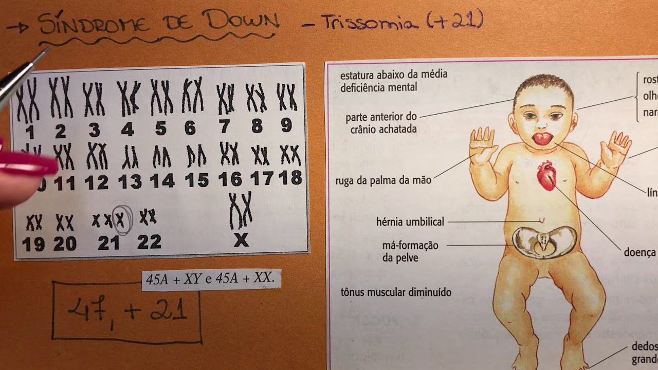 Entendendo As Alterações Cromossômicas Causas Tipos E Consequências