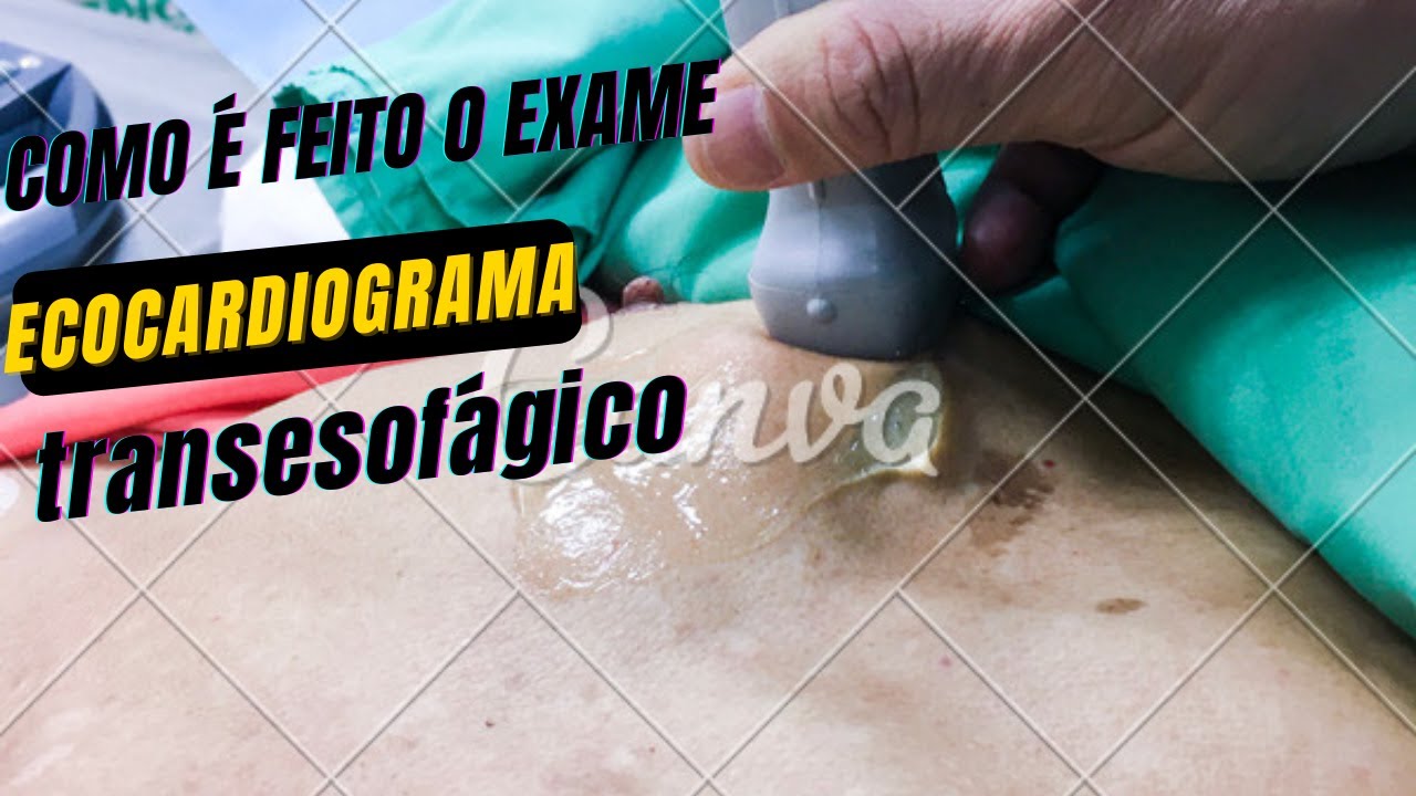 Exame de ecocardiograma transesofágico: saiba como é feito