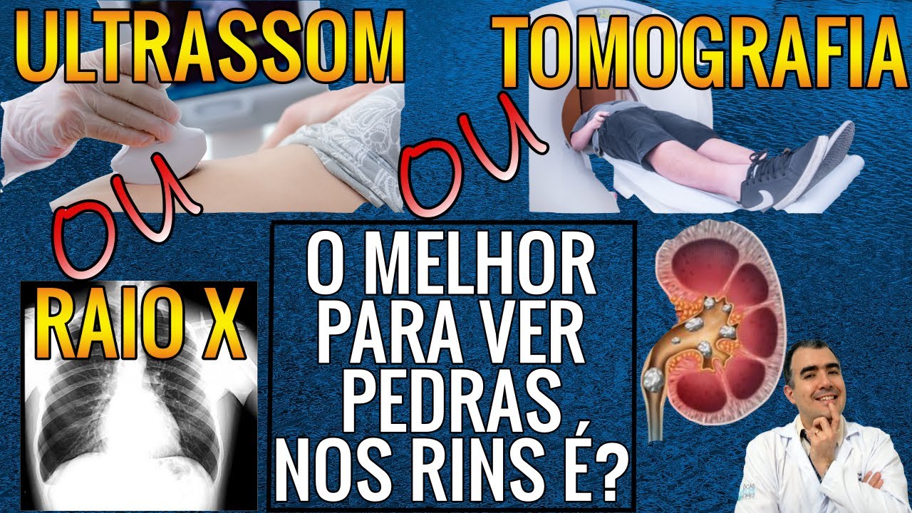Exame para Pedra nos Rins: Identificação e Diagnóstico Preciso da Condição