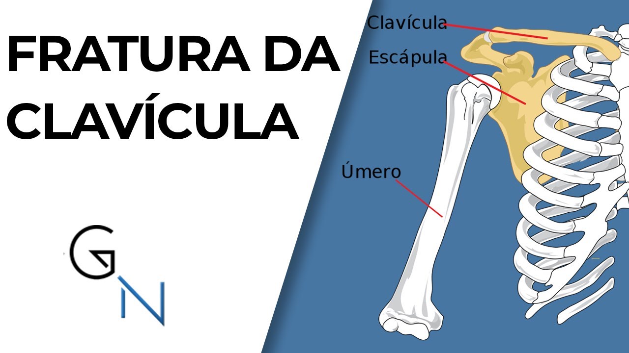 Fratura da clavícula: Quando é necessário cirurgia?
