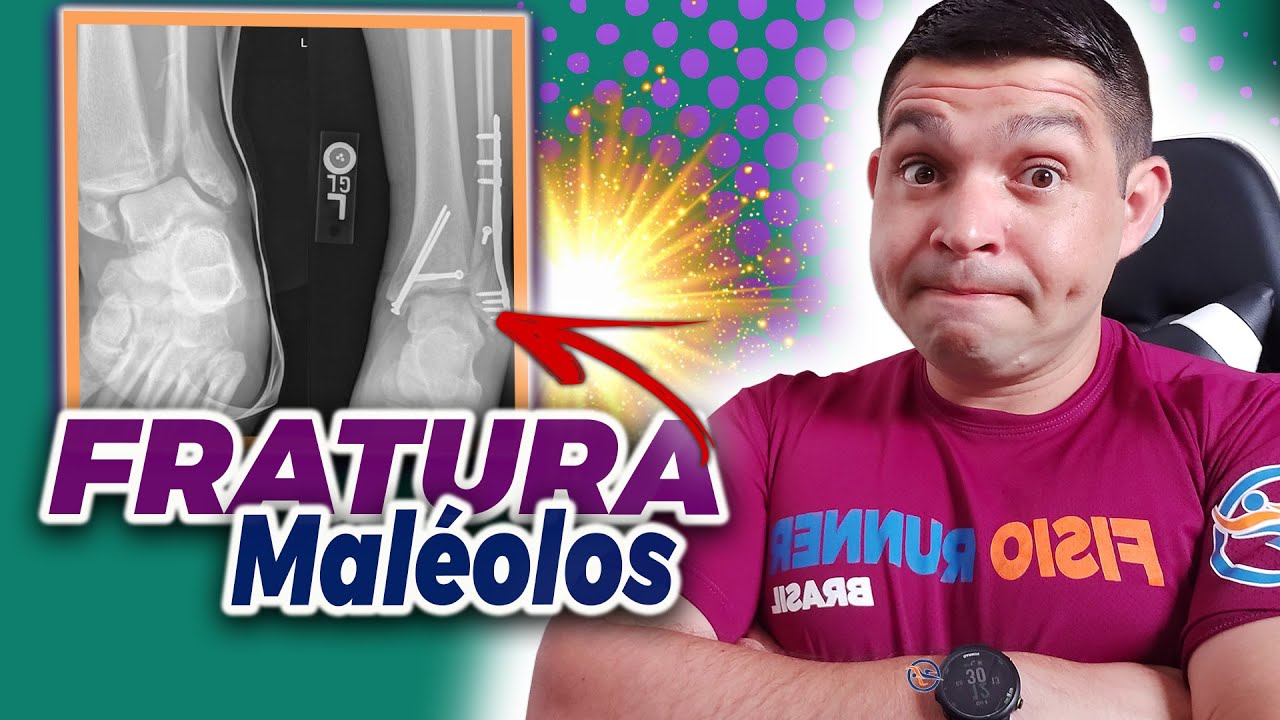 Fratura de maléolo medial e lateral: tempo de recuperação e cuidados ...