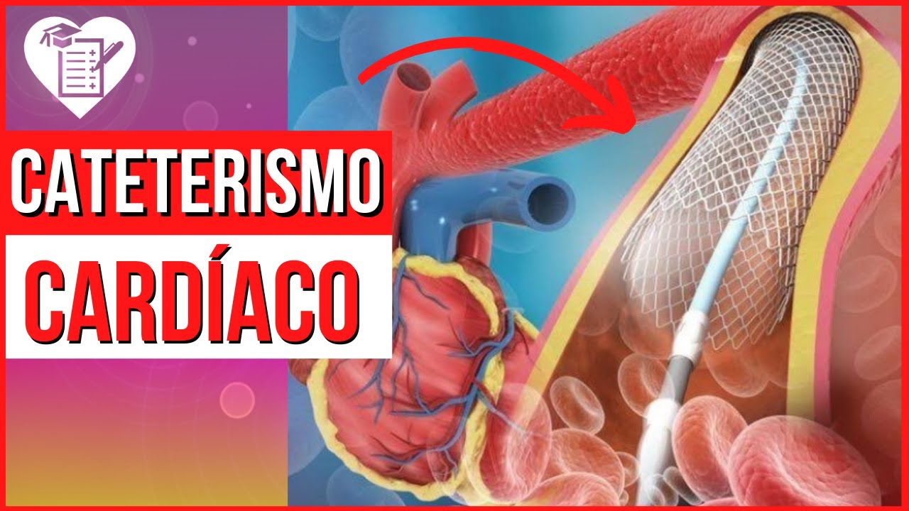 Guia completo sobre cateterismo cardíaco: Tire todas as suas dúvidas