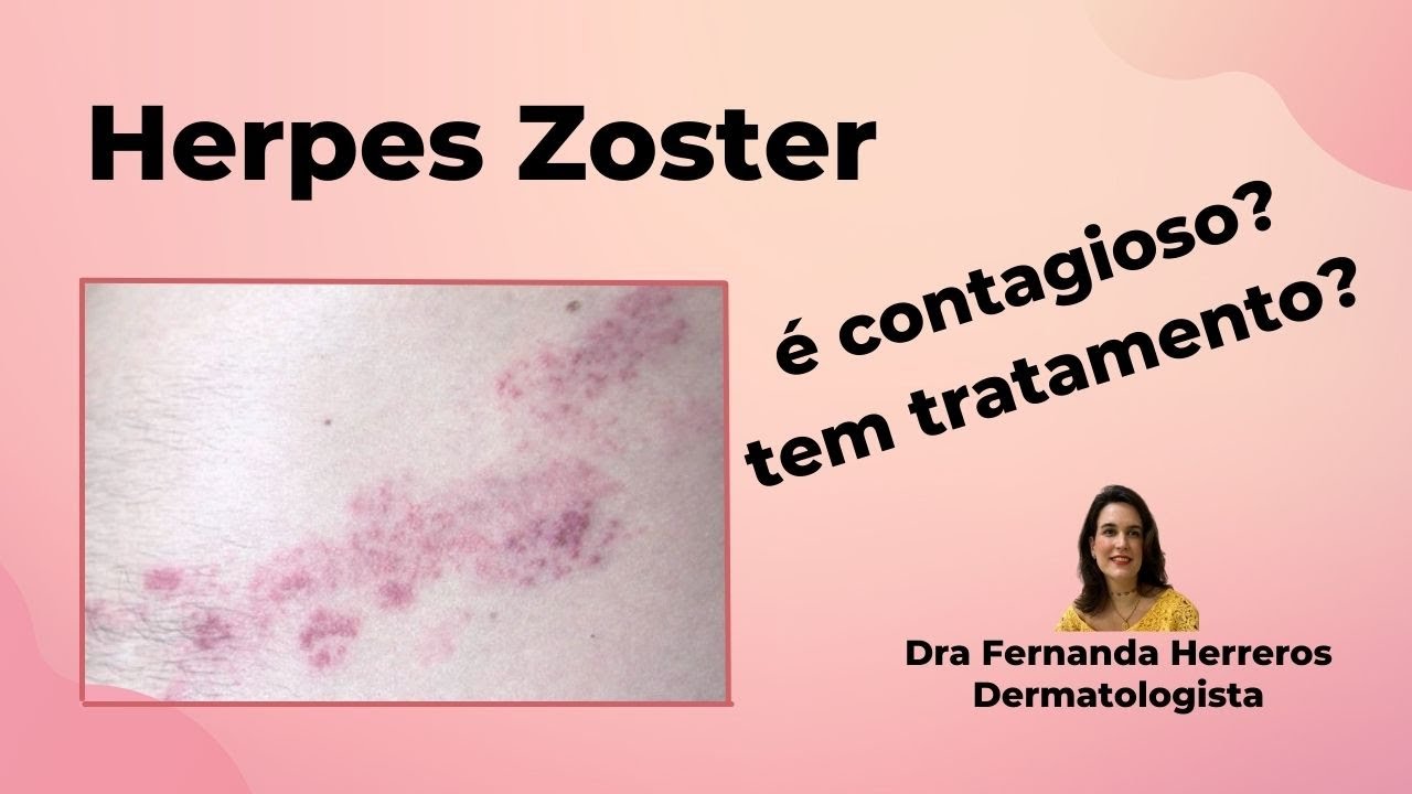 Herpes Zoster: causas, sintomas e tratamentos.