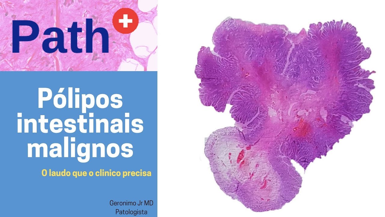 Laudo de Pólipo Intestinal Maligno: O que o clínico precisa saber