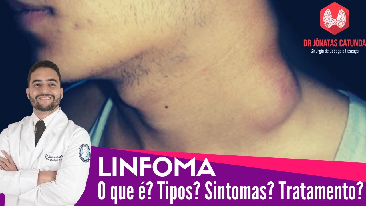 Linfoma: Tipos, Sintomas e Tratamento com Dr. Jônatas Catunda