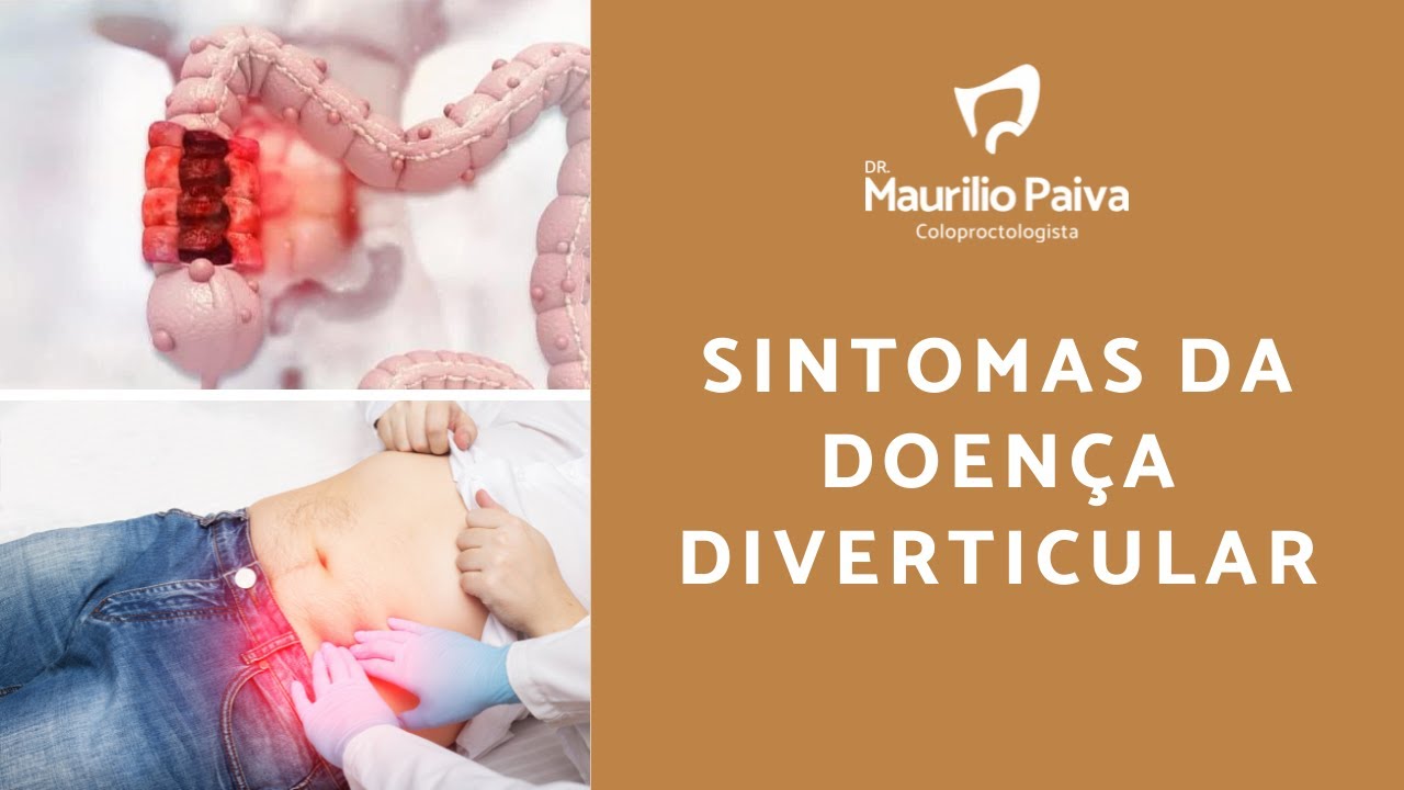 Os principais sinais e sintomas da doença diverticular