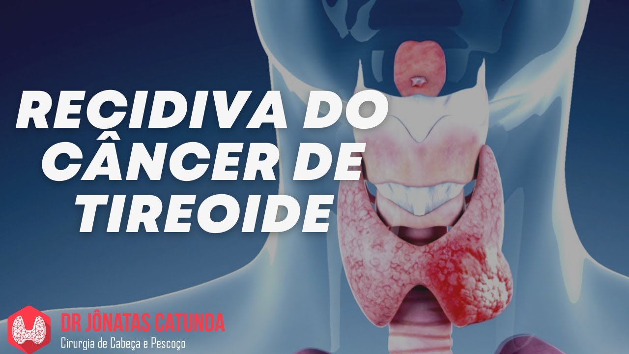 Recidiva do câncer de tireoide: próximos passos para cuidados e ...