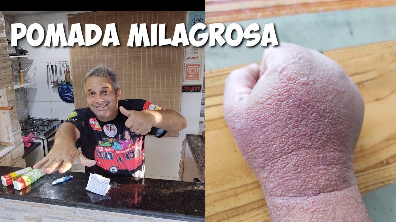 Testei pomada cetobeta genérica para dermatite: incrível resultado ...