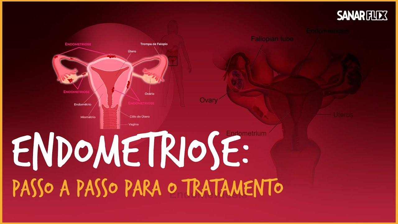 Tratamento da Endometriose: Guia passo a passo no #SanarFlix