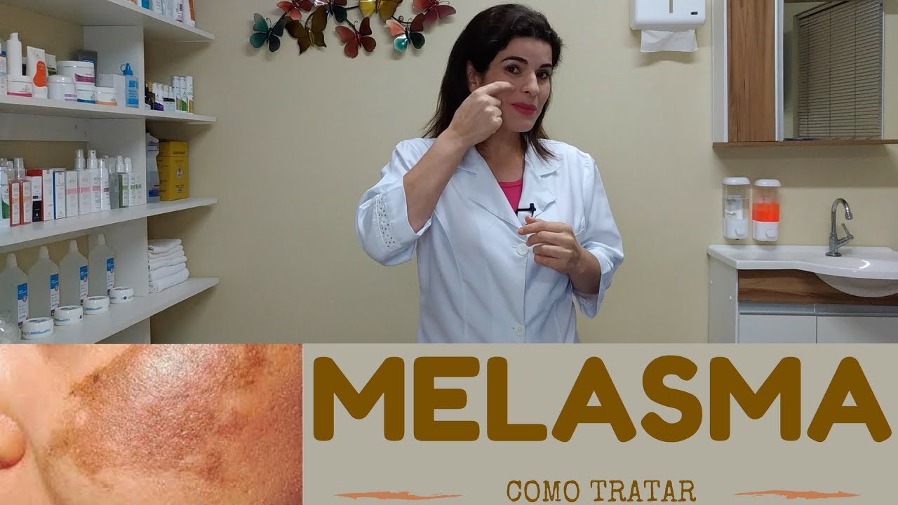 Tratamento para melasma no rosto: cuidados e soluções.