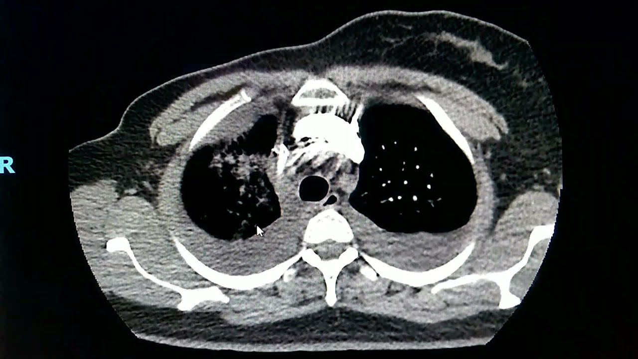 Tromboembolismo pulmonar: técnicas de tomografia para diagnóstico