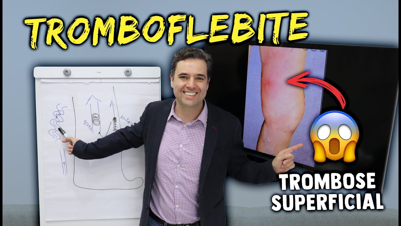 Tromboflebite: sinais, sintomas e tratamentos da trombose superficial