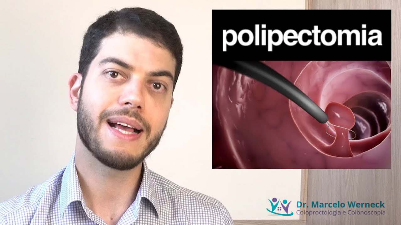 Tudo o que você precisa saber sobre a retirada de pólipos intestinais e ...