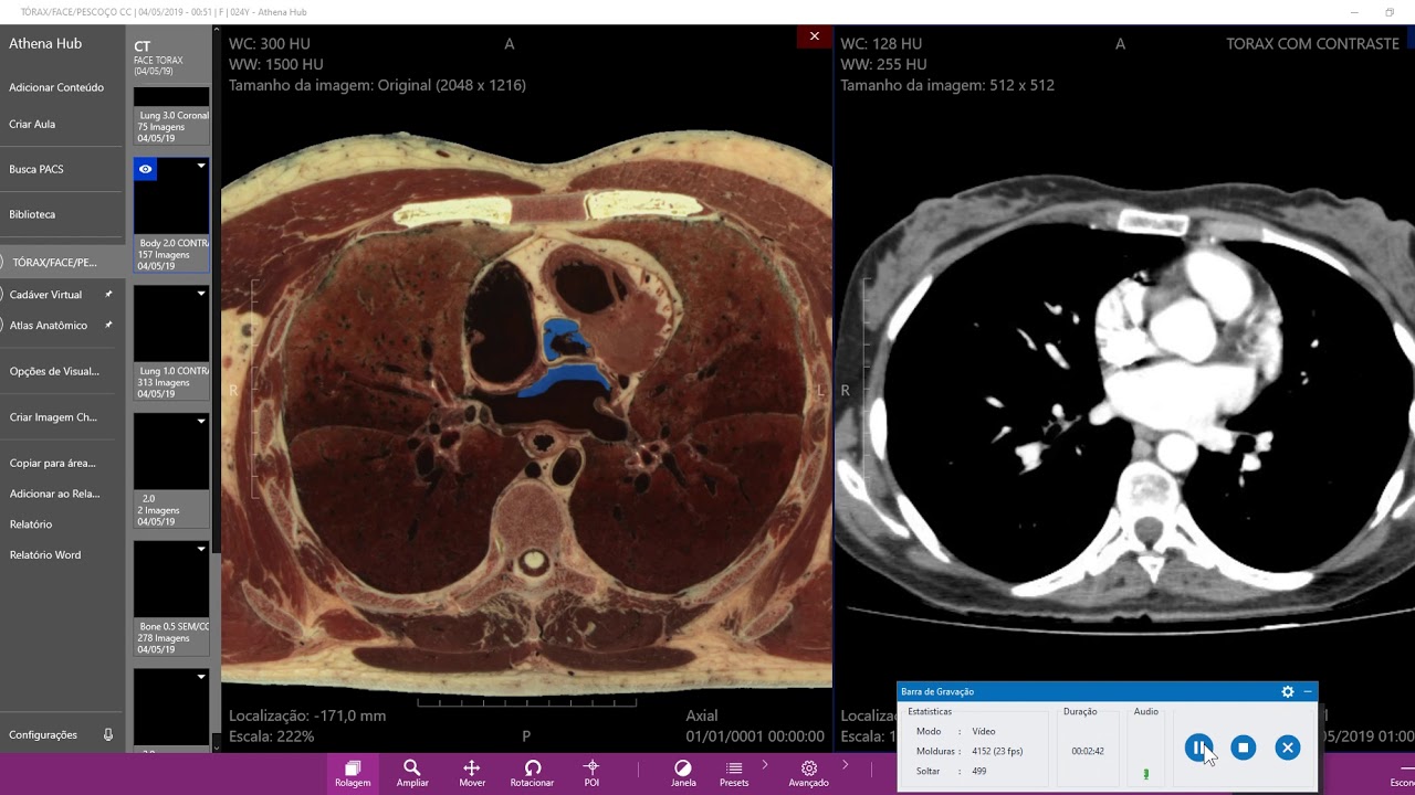 Tudo o que você precisa saber sobre o átrio esquerdo (guia completo)