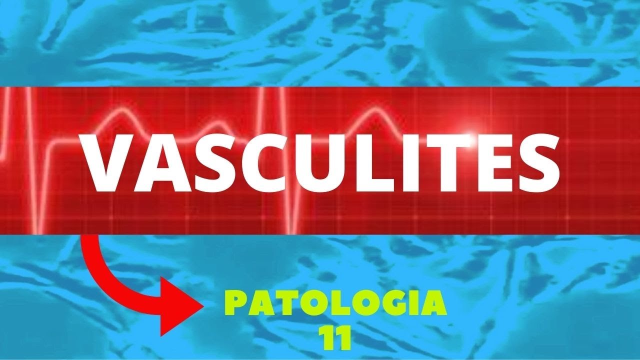 Vasculites: entenda a doença e os diferentes tipos de vasculite ...