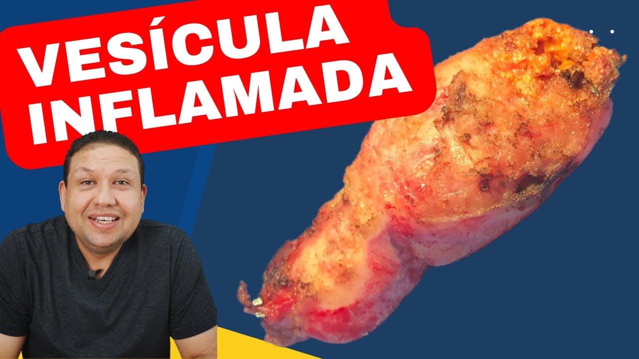 Vesícula inflamada: sintomas, tratamento e pedra na vesícula.