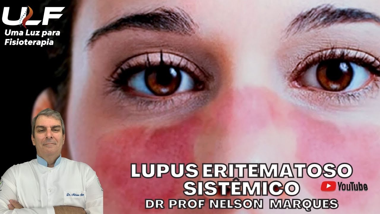 Lupus Eritematoso Sistêmico: informações com Dr. Prof. Nelson Marques