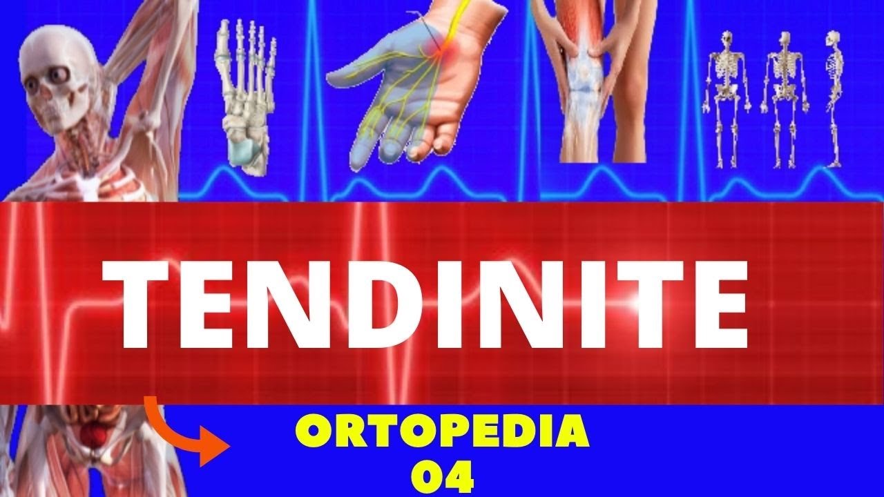 Tendinites: causas, sintomas, diagnóstico e tratamento completos